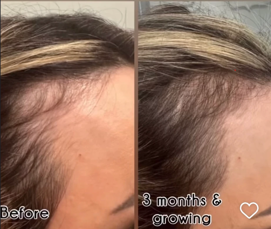 Jet Cool Plasma Royal Oak MI Michigan Advanced Aesthetics